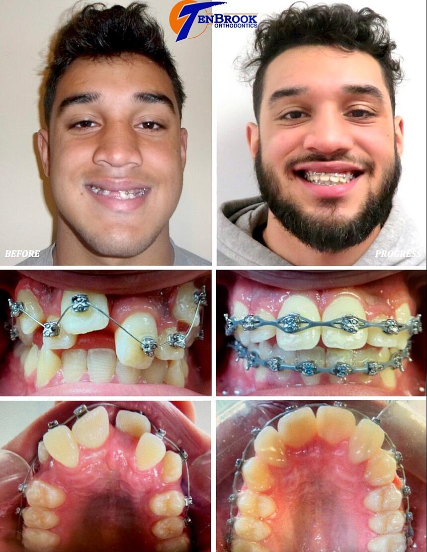 Before And After Braces Adults